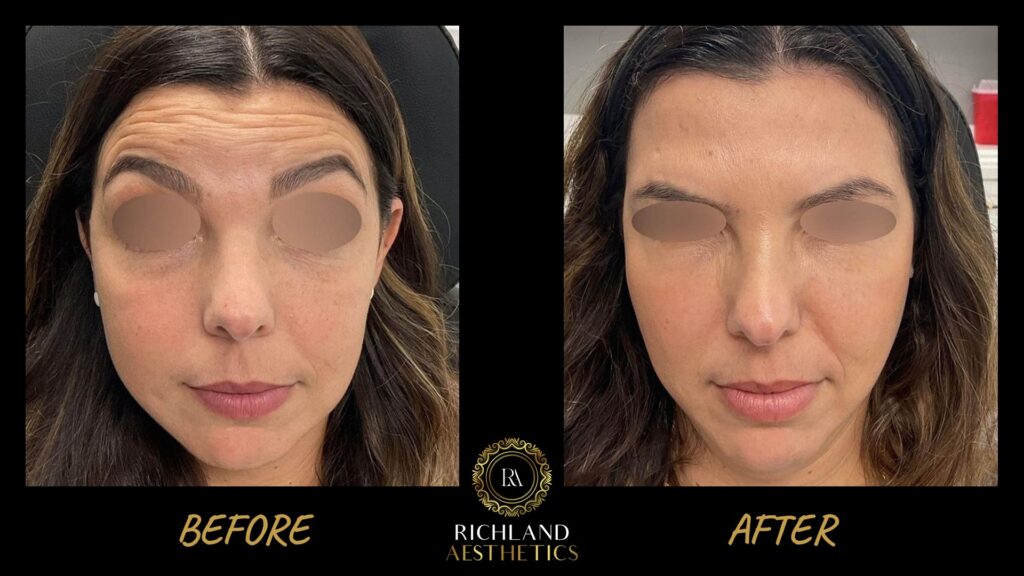 IV Hydration Therapy - Richland Aesthetics