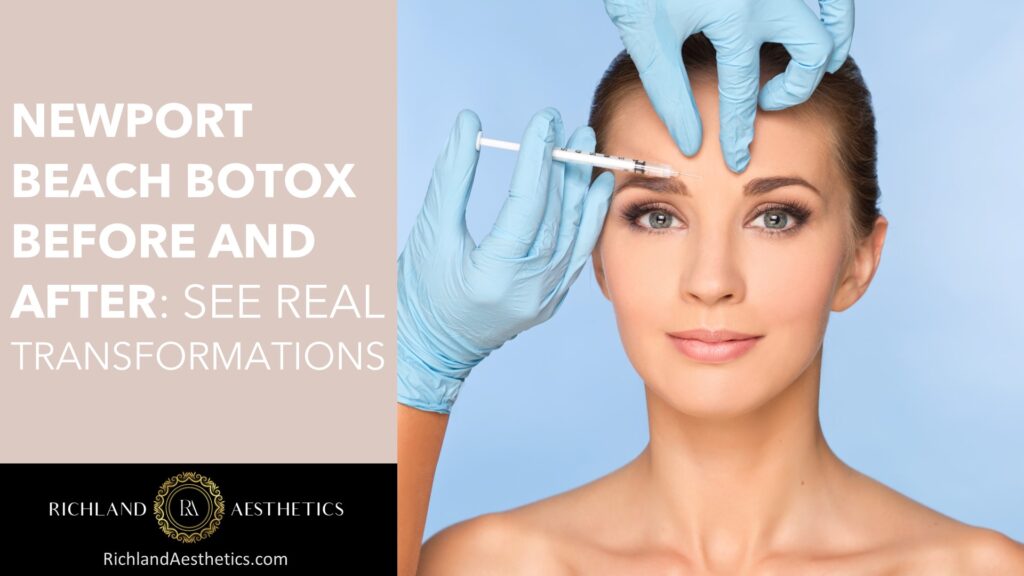 Newport Beach Botox Before and After: See Real Transformations - Richland Aesthetics Luxury Med Spas