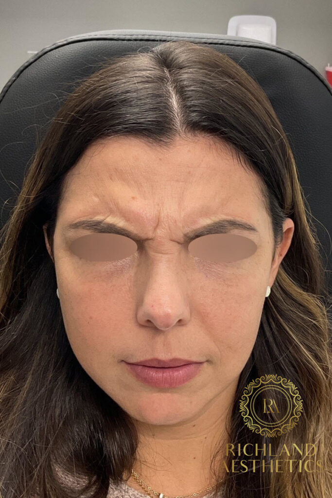 Neurotoxins - Richland Aesthetics Luxury Med Spas