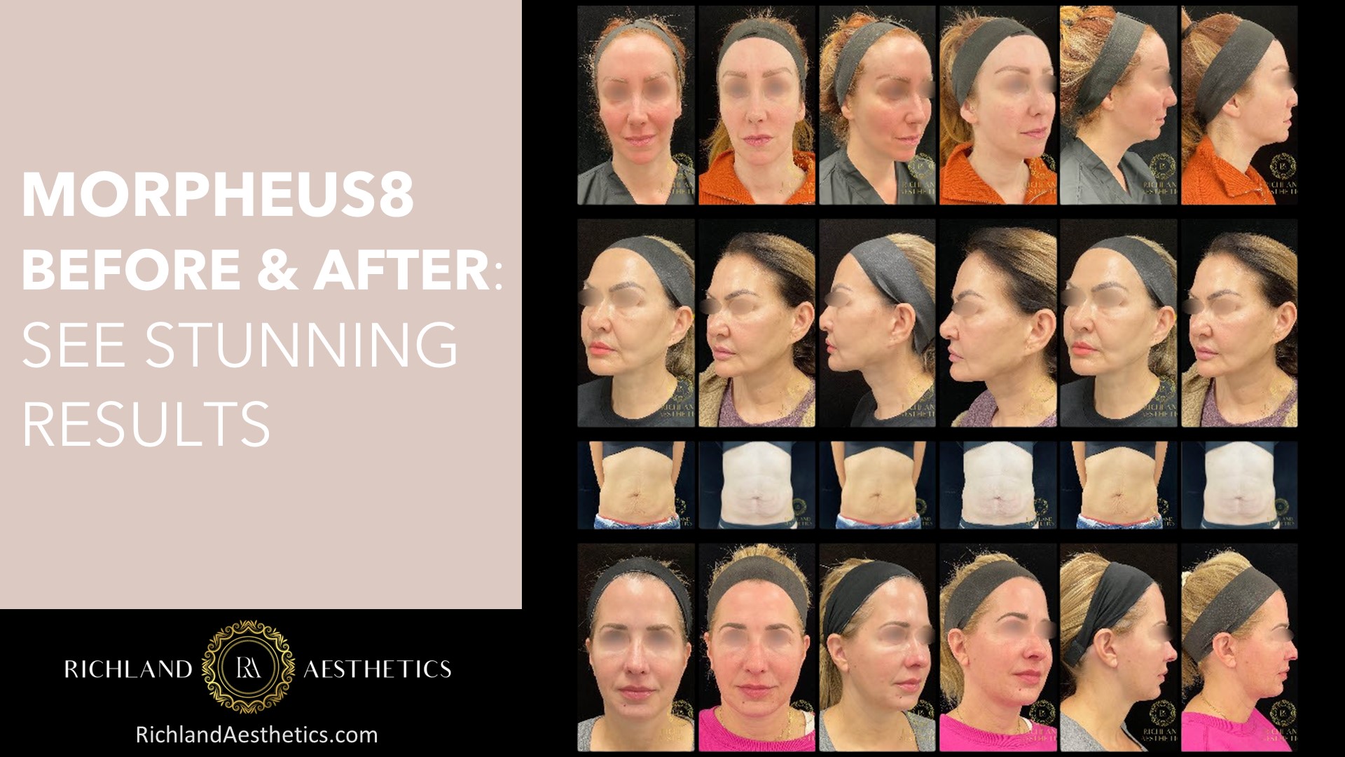 Morpheus8 Before & After: See Stunning Results - Richland Aesthetics Luxury Med Spas